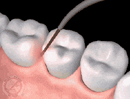 Laser Periodontal Therapy (“LANAP”) | Kurt Van Winkle Periodontics